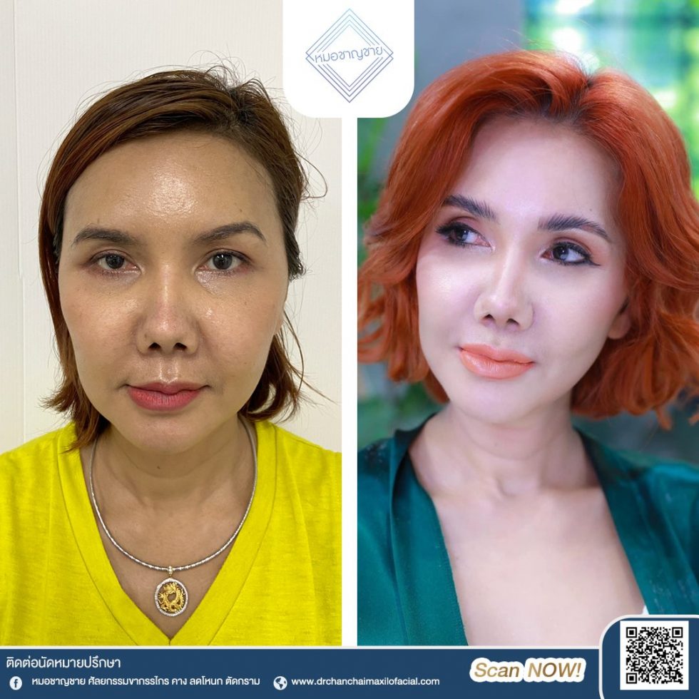 Promotion ยุบโหนก พร้อมดึงไหมเอนโดไทน์ - Dr.Chanchai