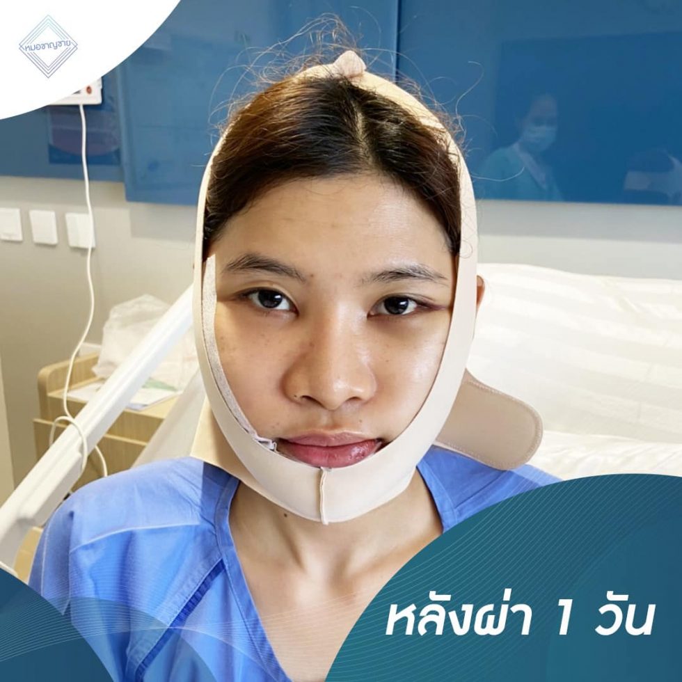 เคสรีวิวยุบโหนก ตัดกราม - Dr.Chanchai