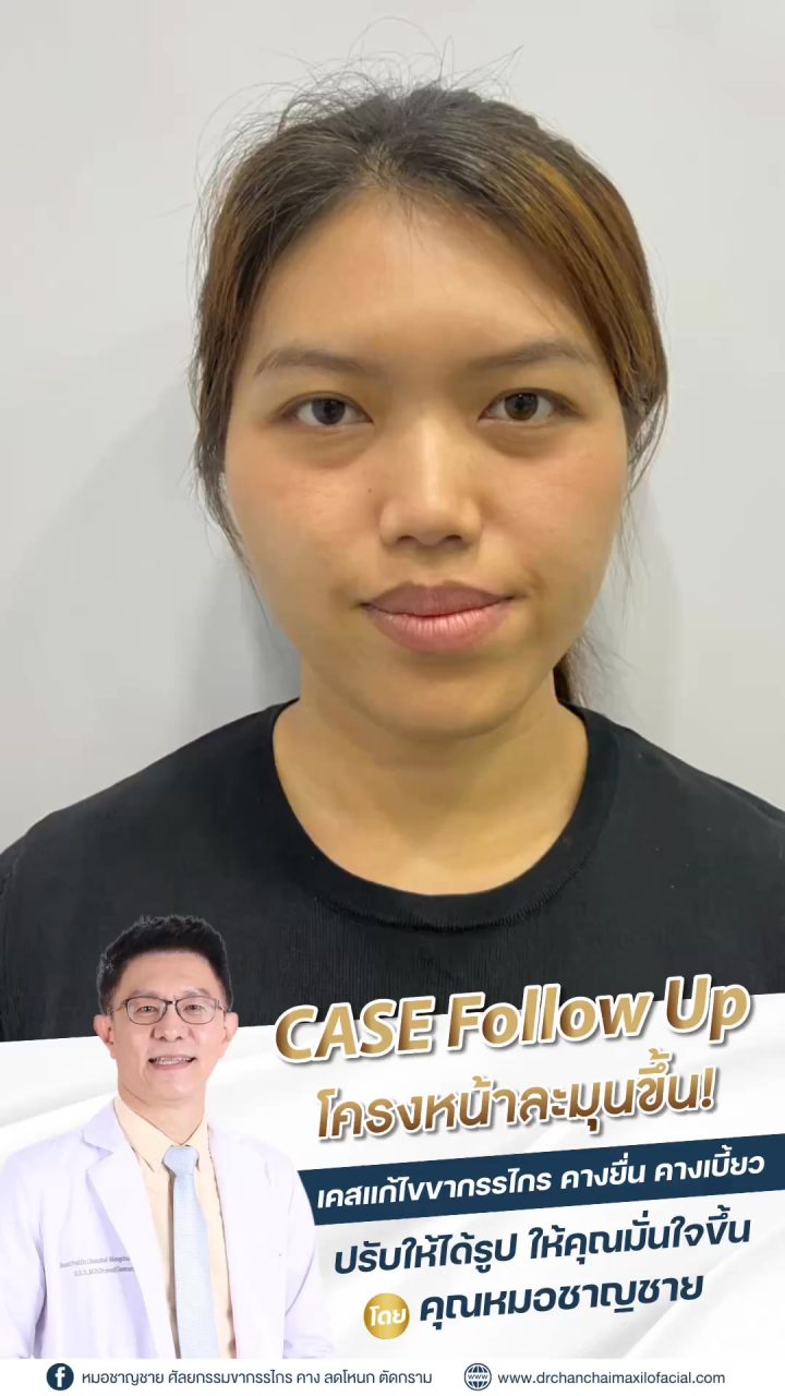 Case Follow Up โครงหน้าละมุนขึ้น! เคสแก้ไขขากรรไกร - Dr.Chanchai